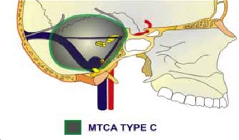 33 Schematic Drawing Showing The Extent Of The Modified Transcochlear Download Scientific