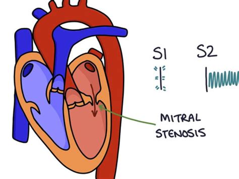 Mitral Stenosis Flashcards Quizlet