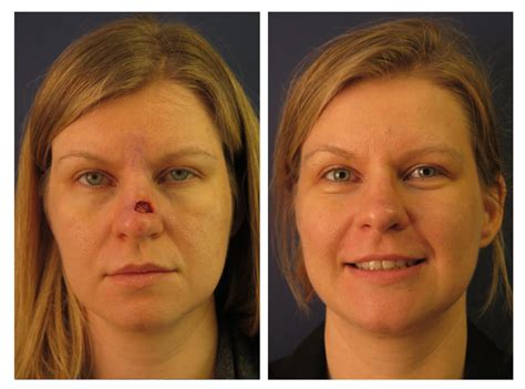 Scar Revision Surgery Cost In India At Herlinda Means Blog
