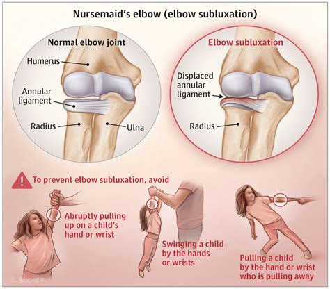 The Nursemaids Elbow Prickly Pear Pediatrics