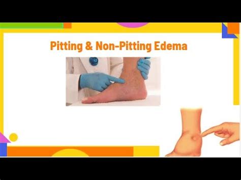 Pitting And Non Pitting Edema Edema Types And Causes Edema