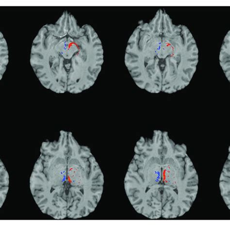 Using Single Shell Clinical Grade Dmri Data To Reconstruct The Download Scientific Diagram