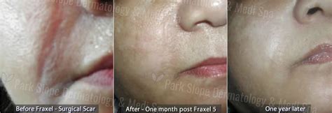 Fraxel Before And After Dermatologist In Brooklyn Ny Brooklyn Nyc