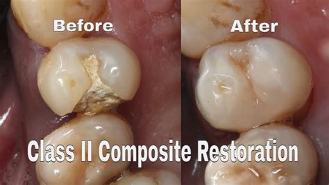 Class Ii Composite Restoration Periodontally Compromised Maxillary