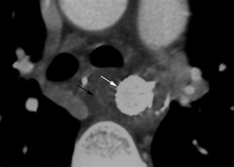 Aortoesophageal Fistula Secondary To Stent Graft Repair Of The Thoracic