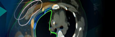 Treatment Planning System Raystation Raysearch Laboratories