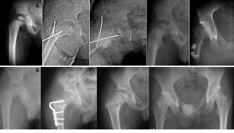 Figure 1 From Clinical And Radiographic Outcomes After Femoral Varus