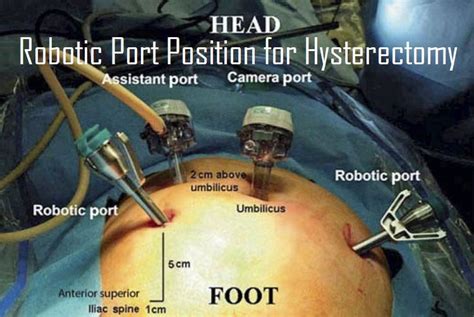 Port Position Of Various Robotic Genaecological Surgeries