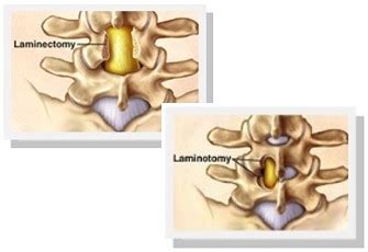 Spinal Decompression Surgery Physiotherapists In Toronto Yorkville
