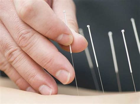 Acupuncture Nerve Pain Relief
