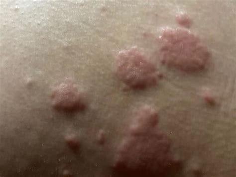 玫瑰糠疹、荨麻疹的原理与治疗 知乎