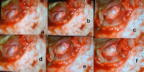 “swinging Door” Technique Of Tympanomeatal Flap Incision Elevation In Type I Tympanoplasty