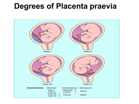 Antepartum Haemorrhage Placenta Previa And Abruptio Placentae Ppt