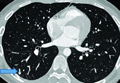 Hereditary Hemorrhagic Telangiectasia Applied Radiology