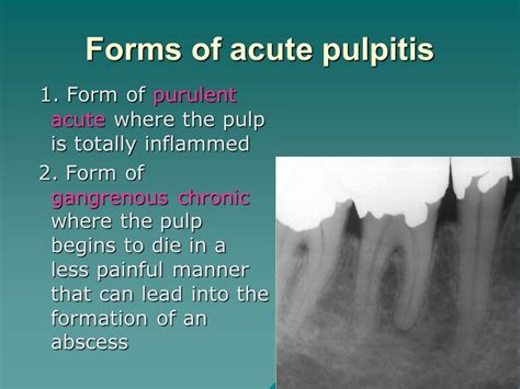 Pulpitis Etiology Pathogenesis Classification Ppt Video Online