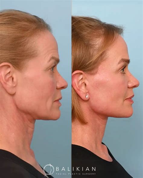 How Facelift Incisions Are Designed For Healing And Natural Results