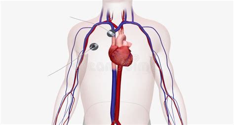 Electrode And Electrical Patch Placement Stock Illustration