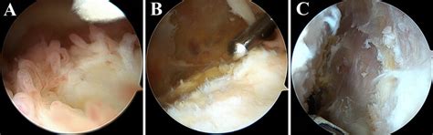 Extensive Hyperplasia Of Hemosiderin Rich Villous Synovium Can Be Seen Download Scientific