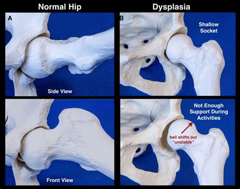 Hip Ball And Socket Joint Dislocation At Thomas Reiser Blog
