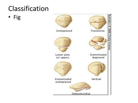 Ppt Fracture Of The Patella Powerpoint Presentation Id394804