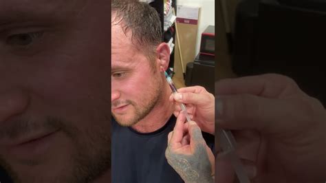 Gym Surgery Cauliflower Ear Youtube