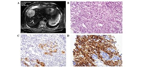 Liver A Mri And Bd Biopsy A A 6 Cm Ill Defined Mass In Hepatic
