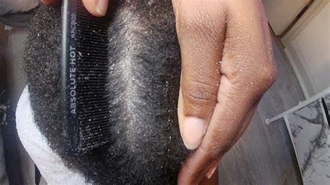 Just Relax And Watch This Dandruff Scratch Youtube