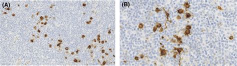 Ebv Positivity Of The Right Cervical Lymph Node A 20× Magnification Download Scientific