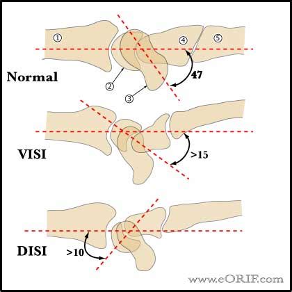 Scapholunate Instability S63519a 84201 Eorif
