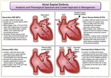 Sinus Venosus Asd