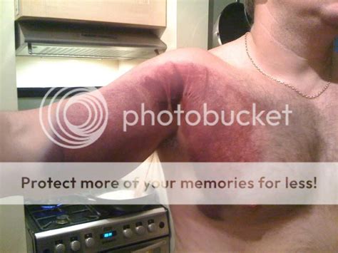 Torn Pec Page 4 Bodybuilding Muscle Fitness And Health Forum