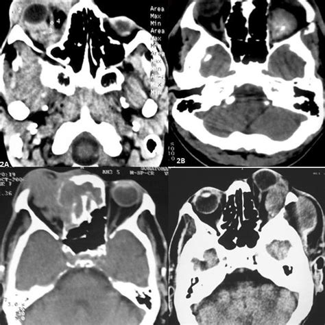 Pdf Computed Tomography Evaluation Of Proptosis