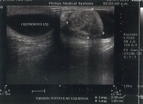 Testicular Torsion Ultrasound