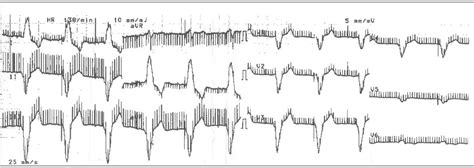 Ecg Artefact What Does It Mean