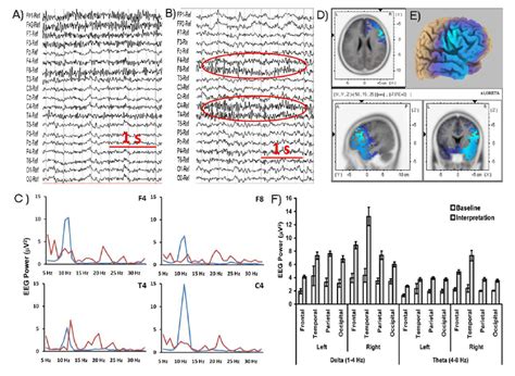 Samples Of Electroencephalographic Patterns And Software Download