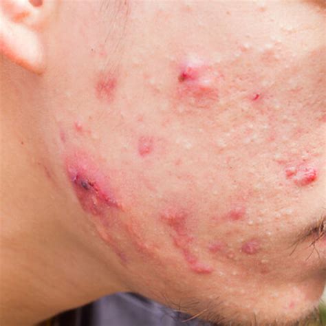 Cortisoneacne Steroid Injections