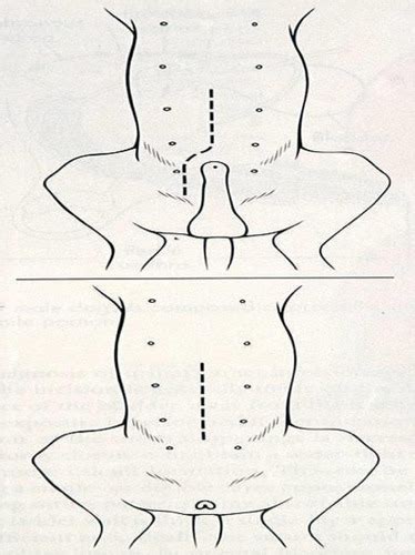 23 Exploratory Celiotomy Flashcards Quizlet