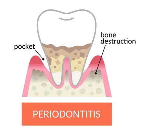 Periodontitis Tooth And Gums Periodontal Pocket And Bone Destruction