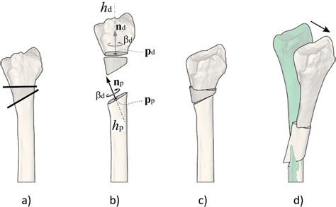 A Rotational Alignment Correction Of A Deformed Bone Using An Oblique