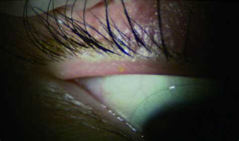 眼瞼炎がんけんえん まやま眼科｜新潟市の眼科医院