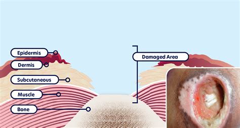 Epuap Pressure Ulcer Classification 2019 Part 1 Activheal® Academy