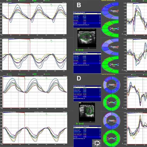 Global And Regional Strain And Strain Rate Analyses In Parasternal