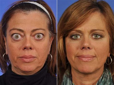 Patient 414080 Thyroid Eye Disease Before And After Photos W Cosmetic Surgery