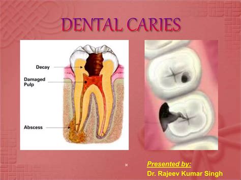 Dental Caries Ppt Ppt Dental Caries Ppt Ppt