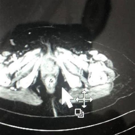 Pdf Abdominal Perineal Resection Surgery Case Report