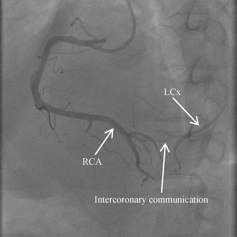 Selective Rca Angiography Showed Retrograde Filling Of Distal Lcx From Download Scientific