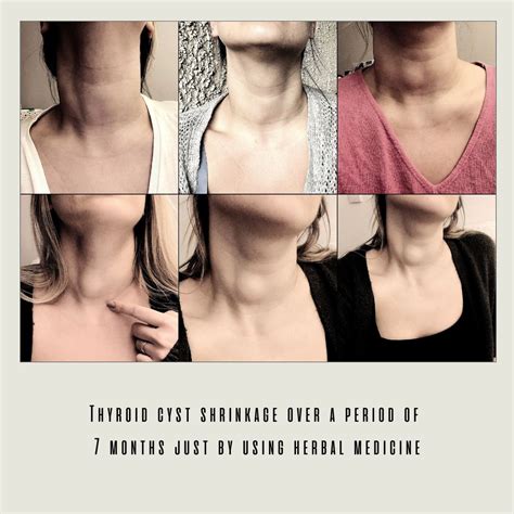 Darko Trogrlic On Linkedin Thyroid Endocrinolohy Cyst Holistic