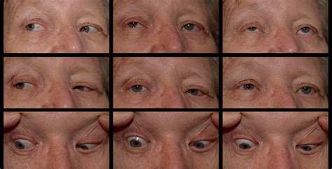 Atlas Entry Facial Colliculus Syndrome