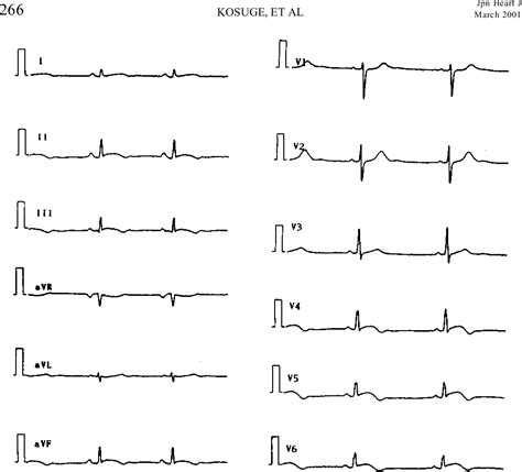 Figure 1 From Left Ventricular Apical Aneurysm In Cardiac Sarcoidosis Semantic Scholar