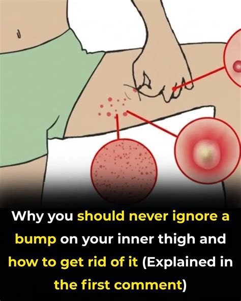 The Most Effective Ways To Get Rid Of Bumps On Inner Thigh Backed By Science